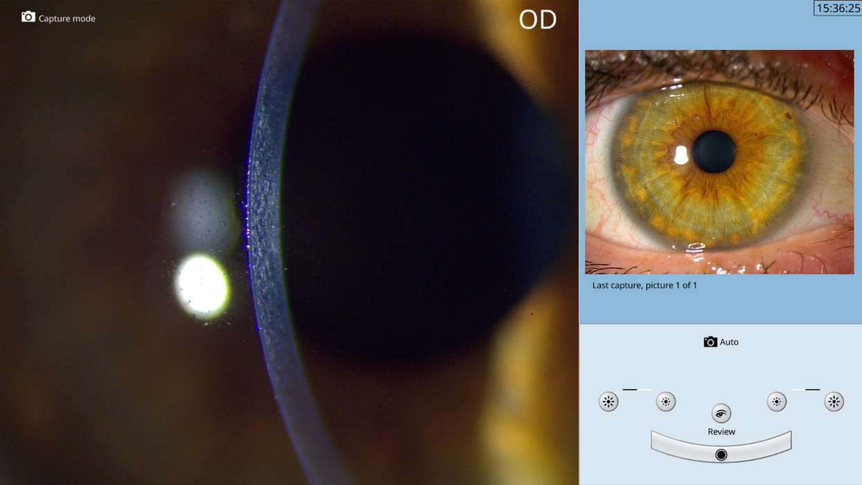 Slit lamp imaging