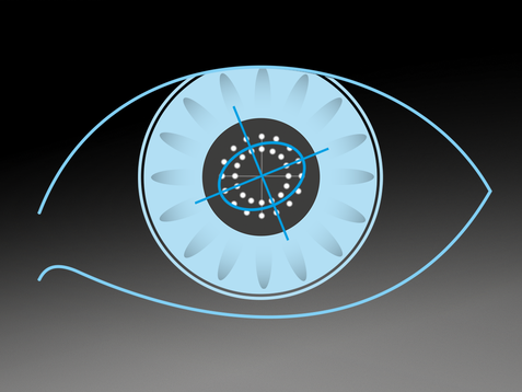 Lenstar 900 - High precision keratometry & topography