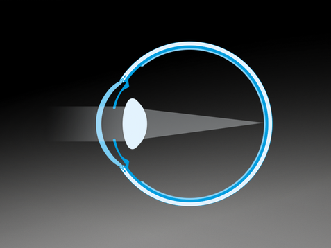 Myopia management